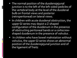 Midgut volvulus | PPTX