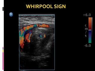 Volvulus Ultrasound