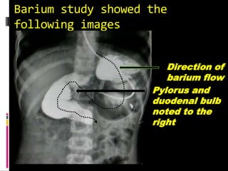 Midgut Volvulus X Ray