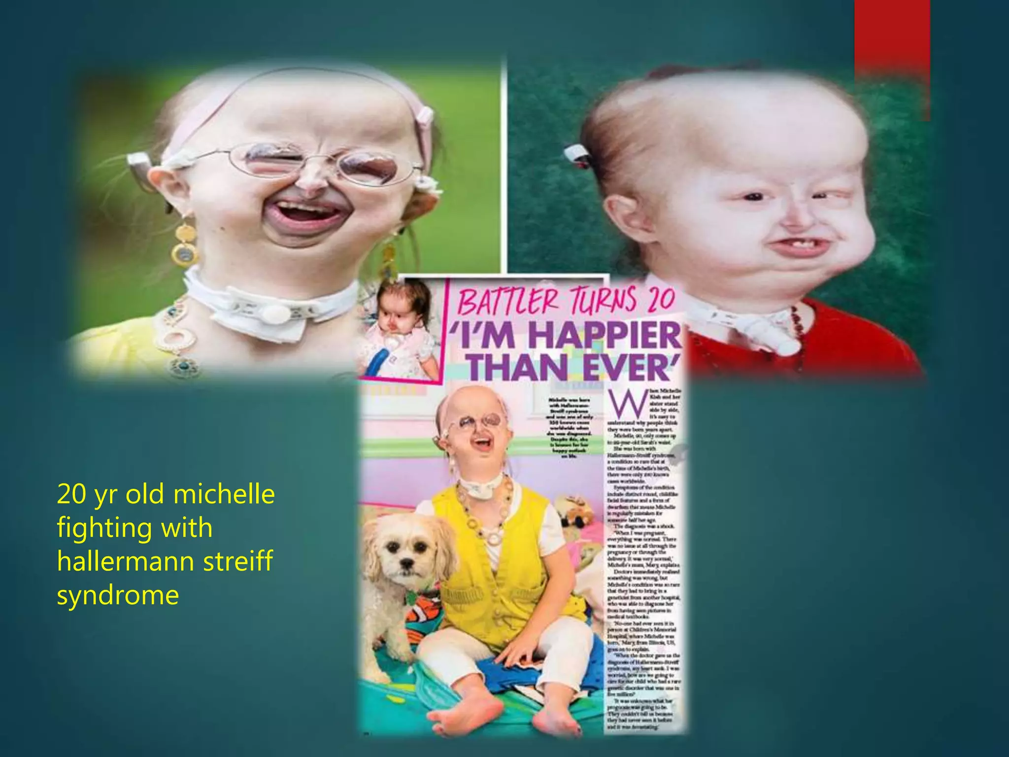 Hallermann streiff syndrome | PPT