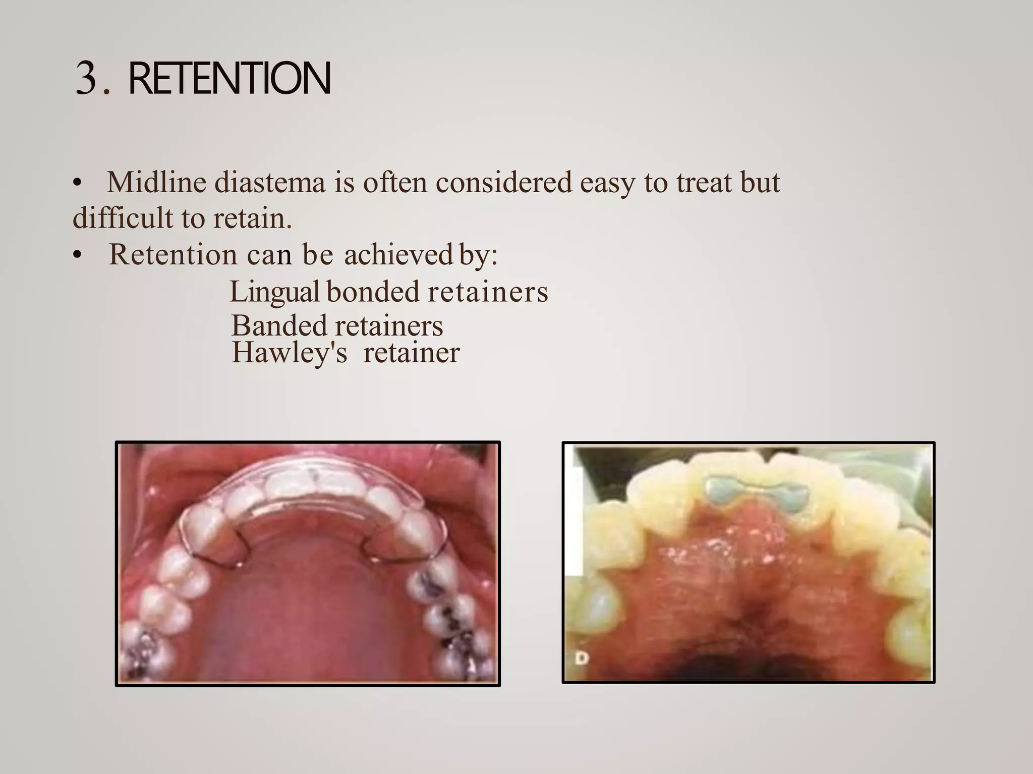 midline diastema-1.pptx
