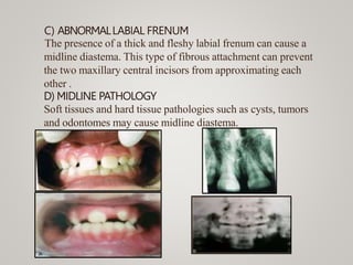 midline diastema-1.pptx