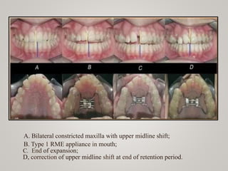 midline diastema-1.pptx