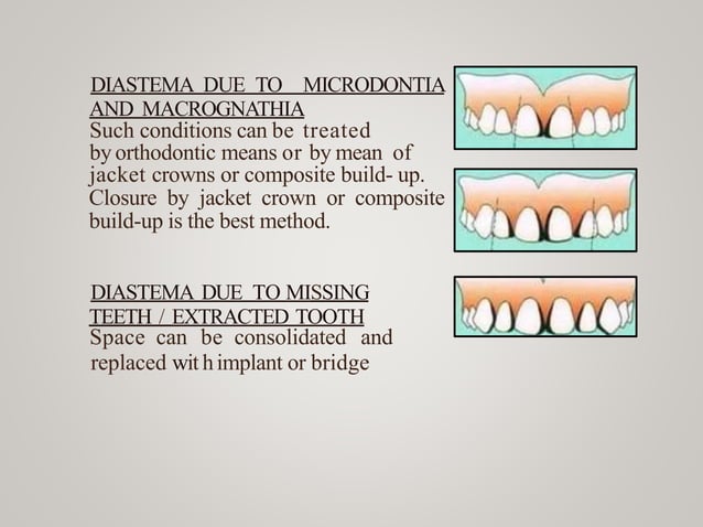 Midline Diastema 1 Pptx