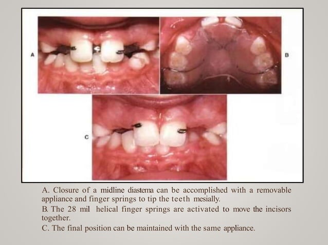 Midline Diastema 1 Pptx