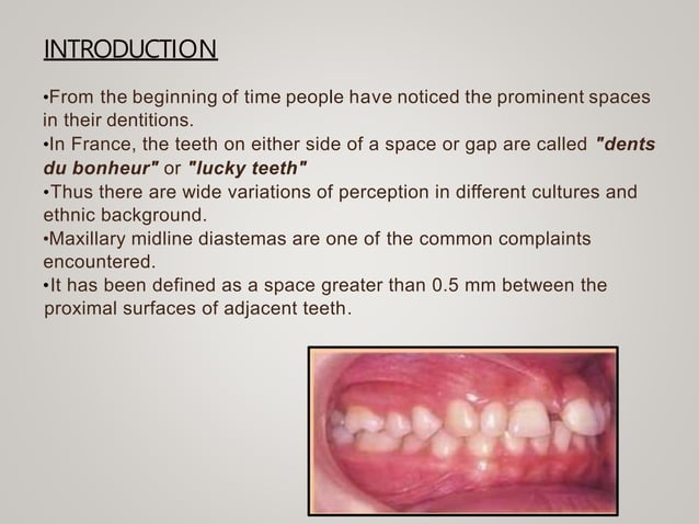 Midline Diastema 1 Pptx