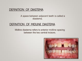 midline diastema-1.pptx