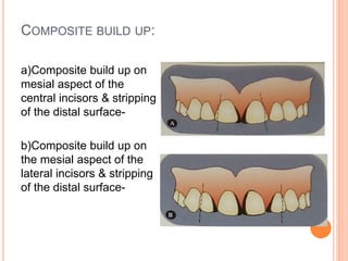 Midline diastema in children and adults | PPTX
