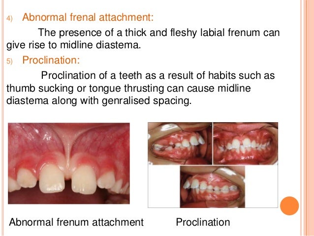 Midline diastema in children and adults