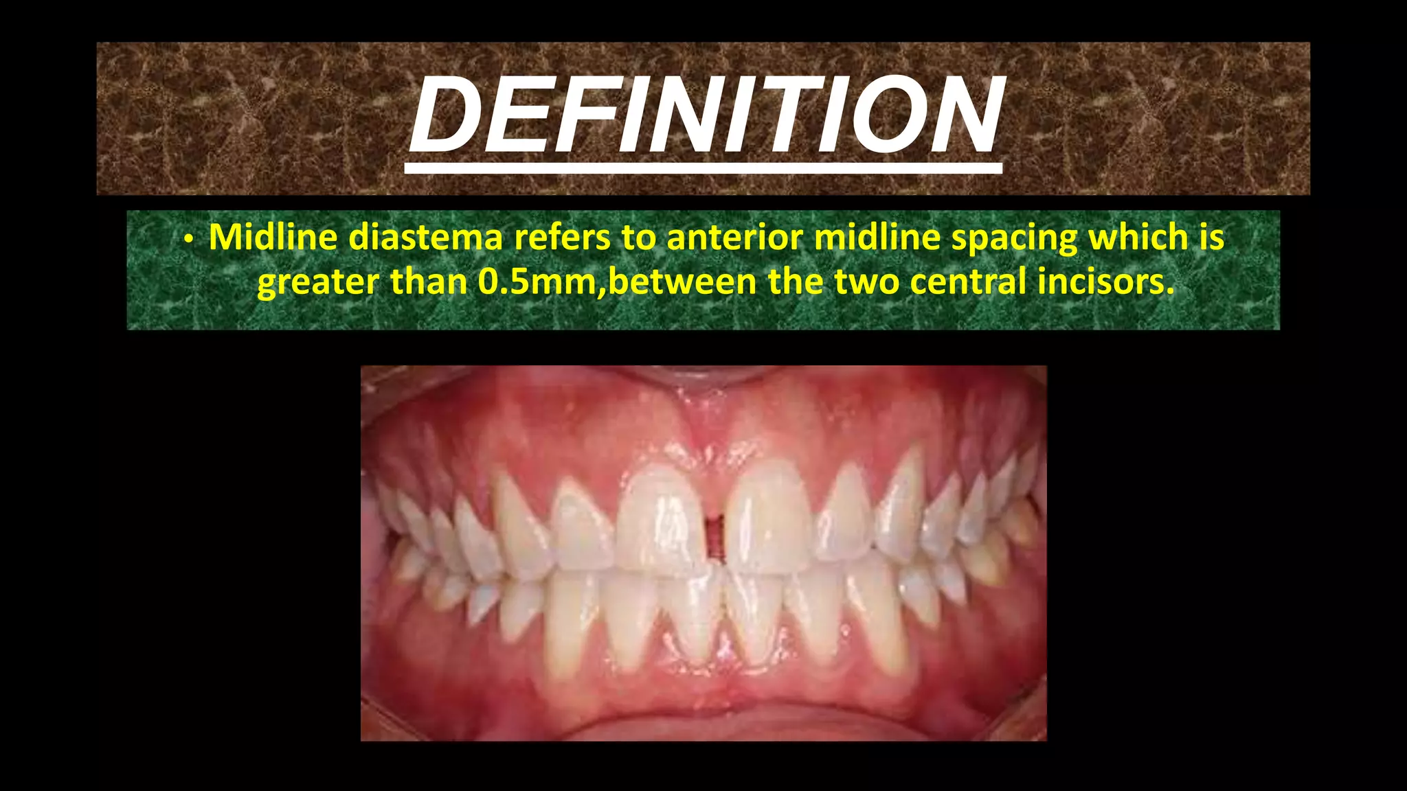 Midline diastema | PPTX