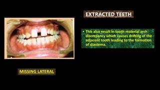Midline diastema | PPTX
