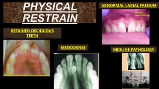 Midline diastema | PPTX