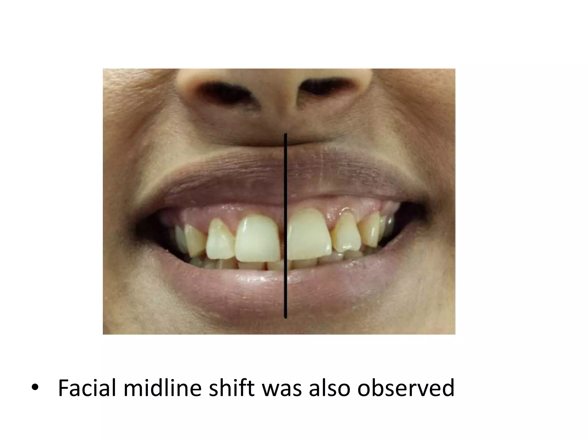 Midline diastema dr arsalan | PPTX