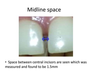 Midline diastema dr arsalan | PPT