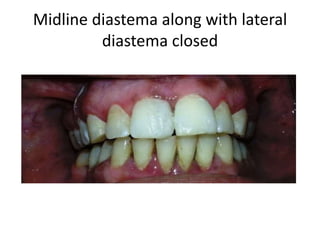 Midline diastema dr arsalan | PPT