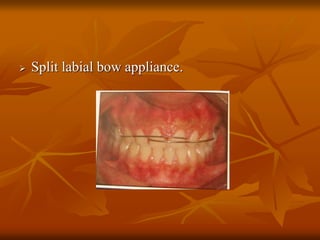 Midline diastema O.ppt