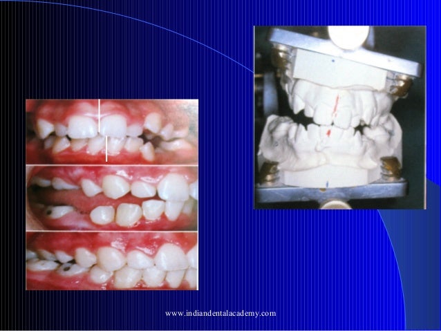 Midline shift /certified fixed orthodontic courses by Indian dental a…