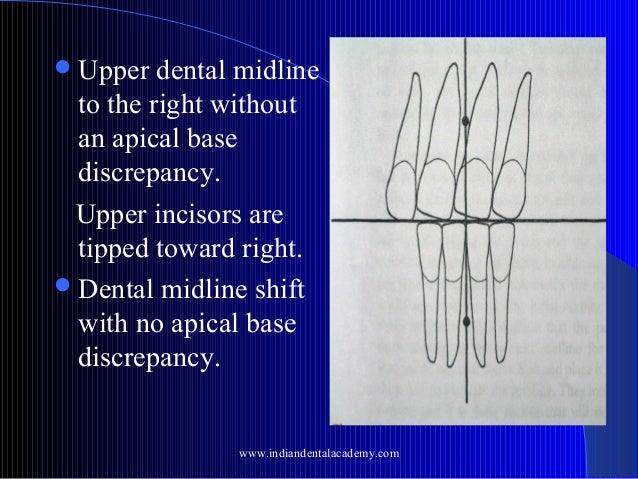 Midline shift /certified fixed orthodontic courses by Indian dental a…