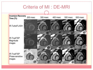 Myocardial Infraction diagnosis using CT-Scan & MRI | PPT