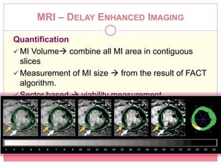 Myocardial Infraction diagnosis using CT-Scan & MRI | PPT