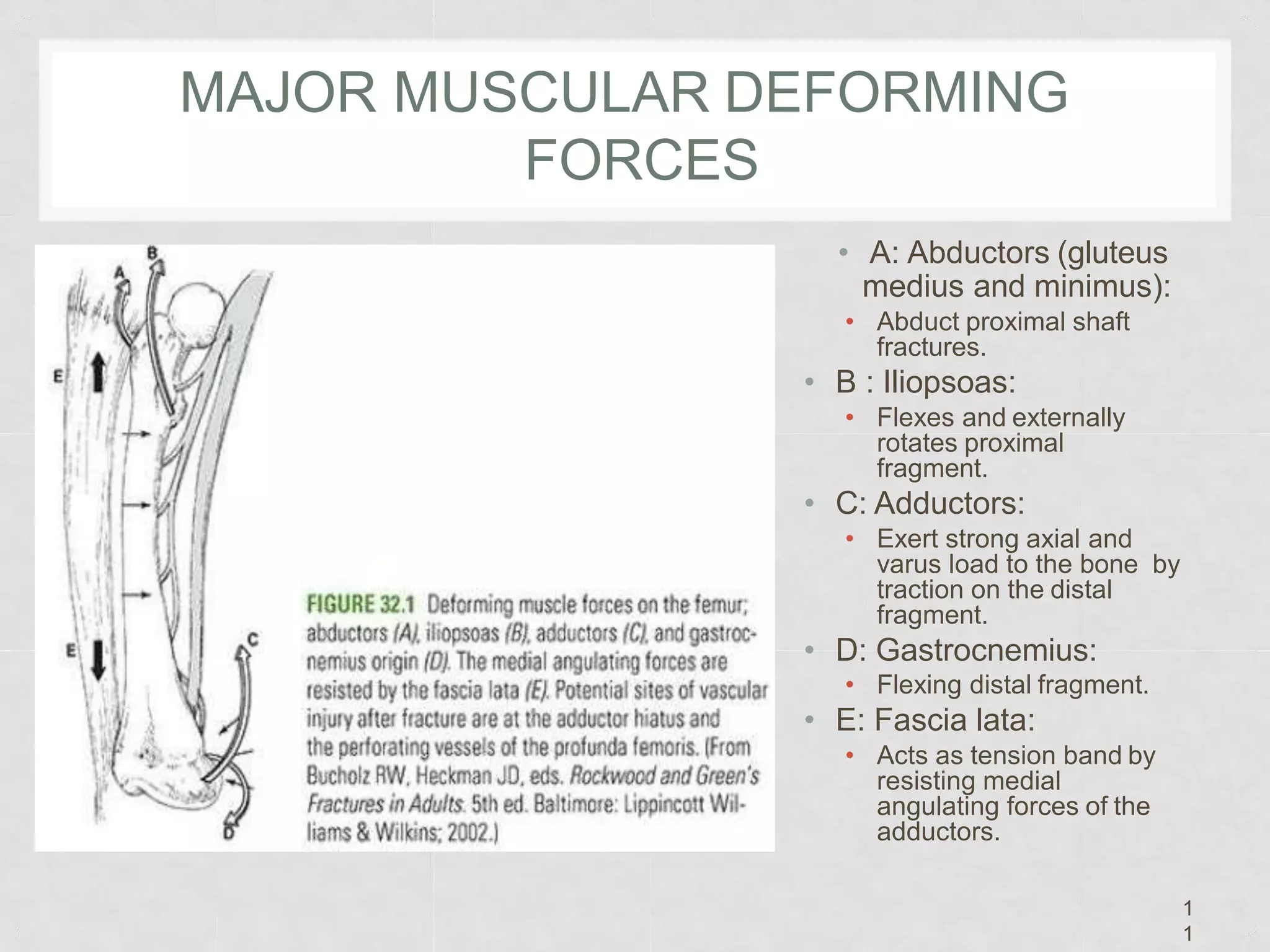 Midshaft femur fracture | PPTX