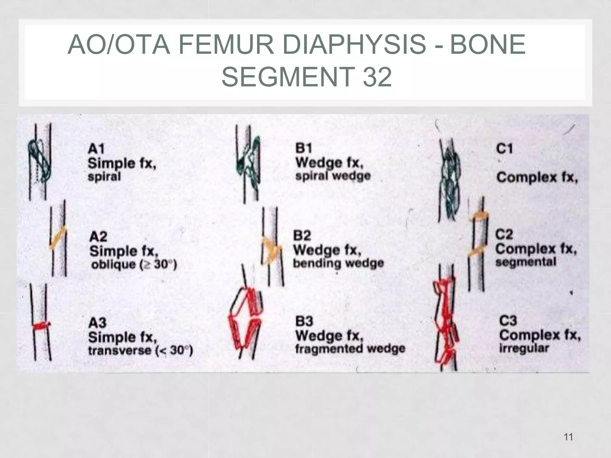 Midshaft femur fracture | PPTX