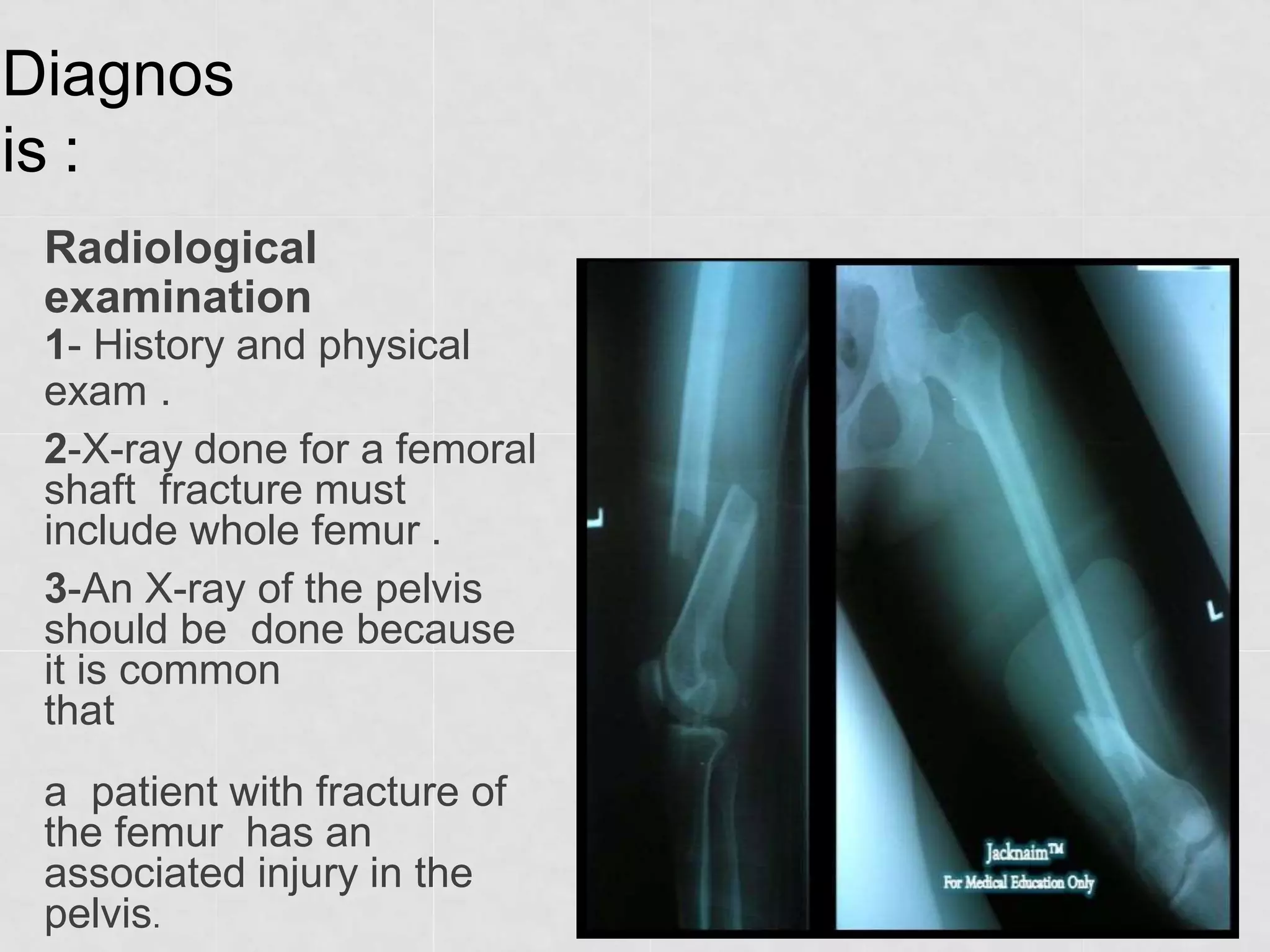 Midshaft femur fracture | PPTX