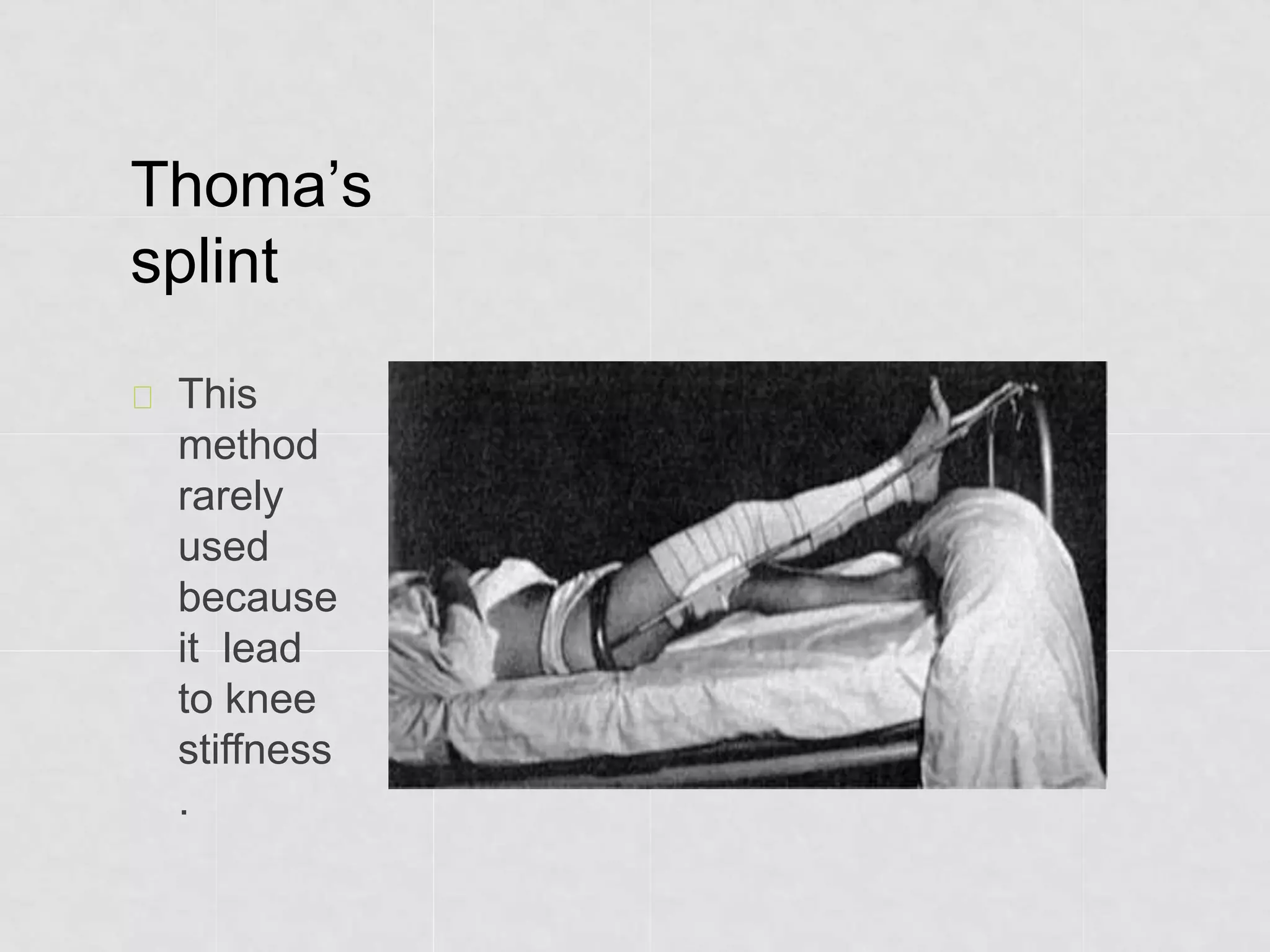 Midshaft femur fracture | PPTX