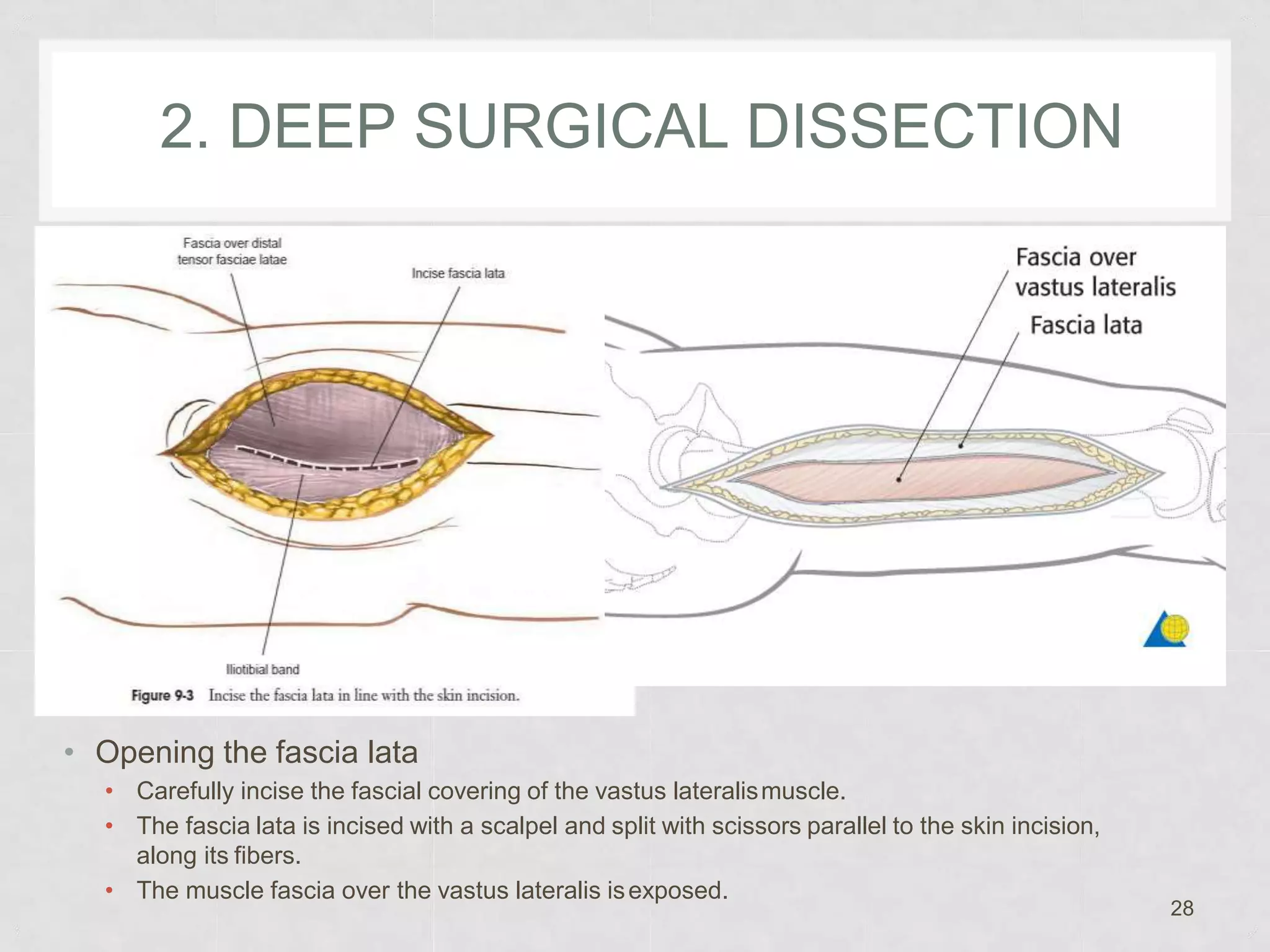 Midshaft femur fracture | PPTX