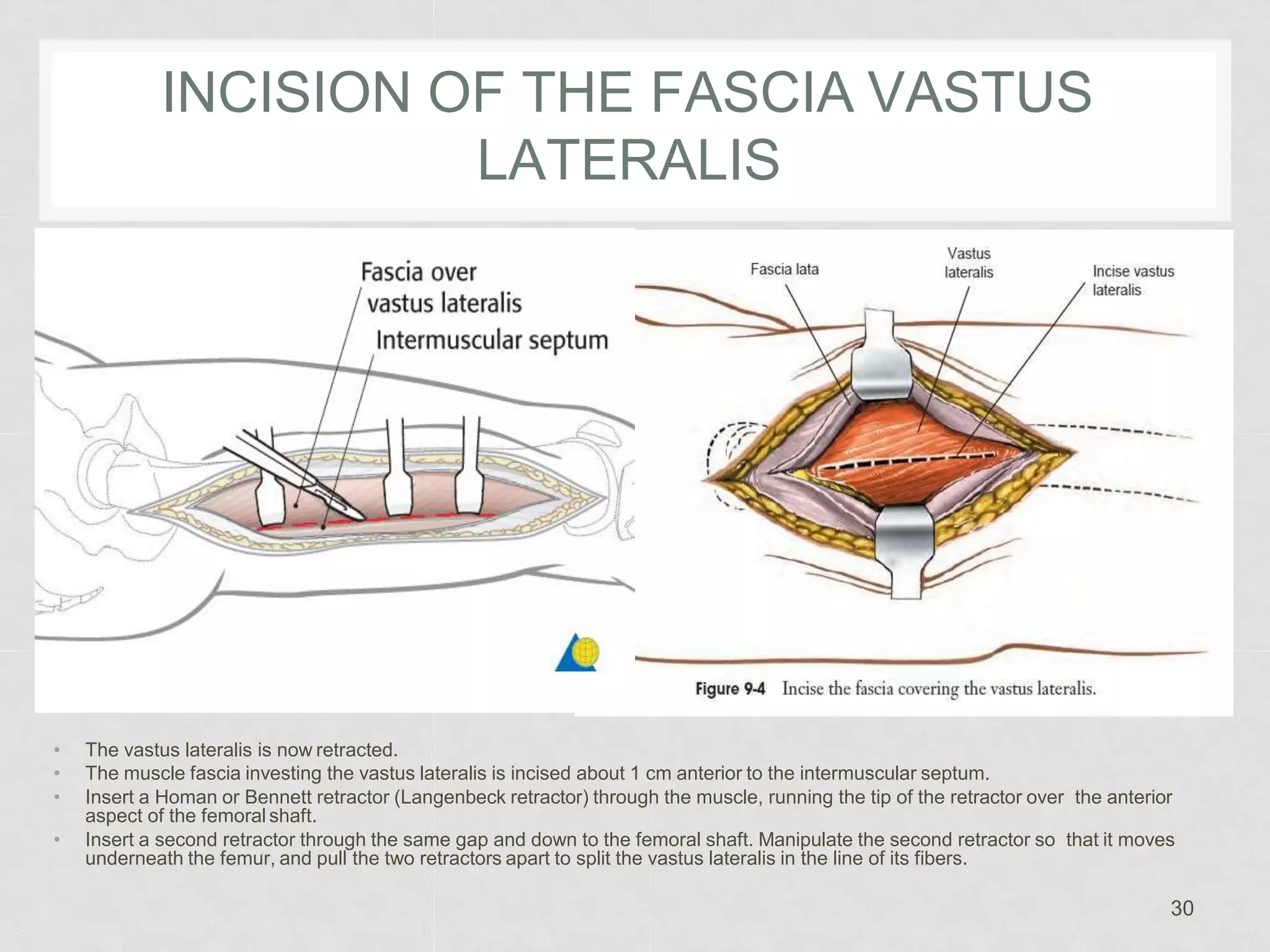 Midshaft femur fracture | PPTX