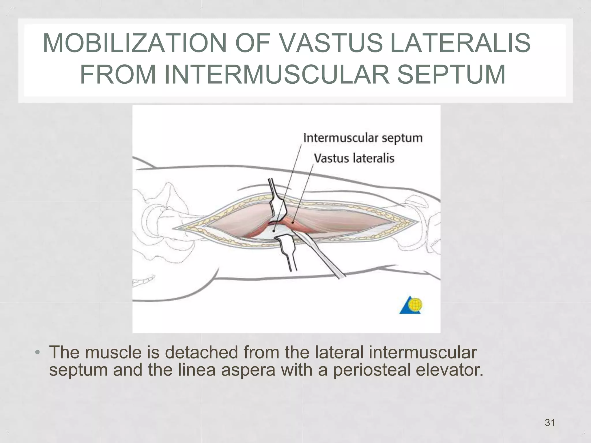 Midshaft femur fracture | PPTX