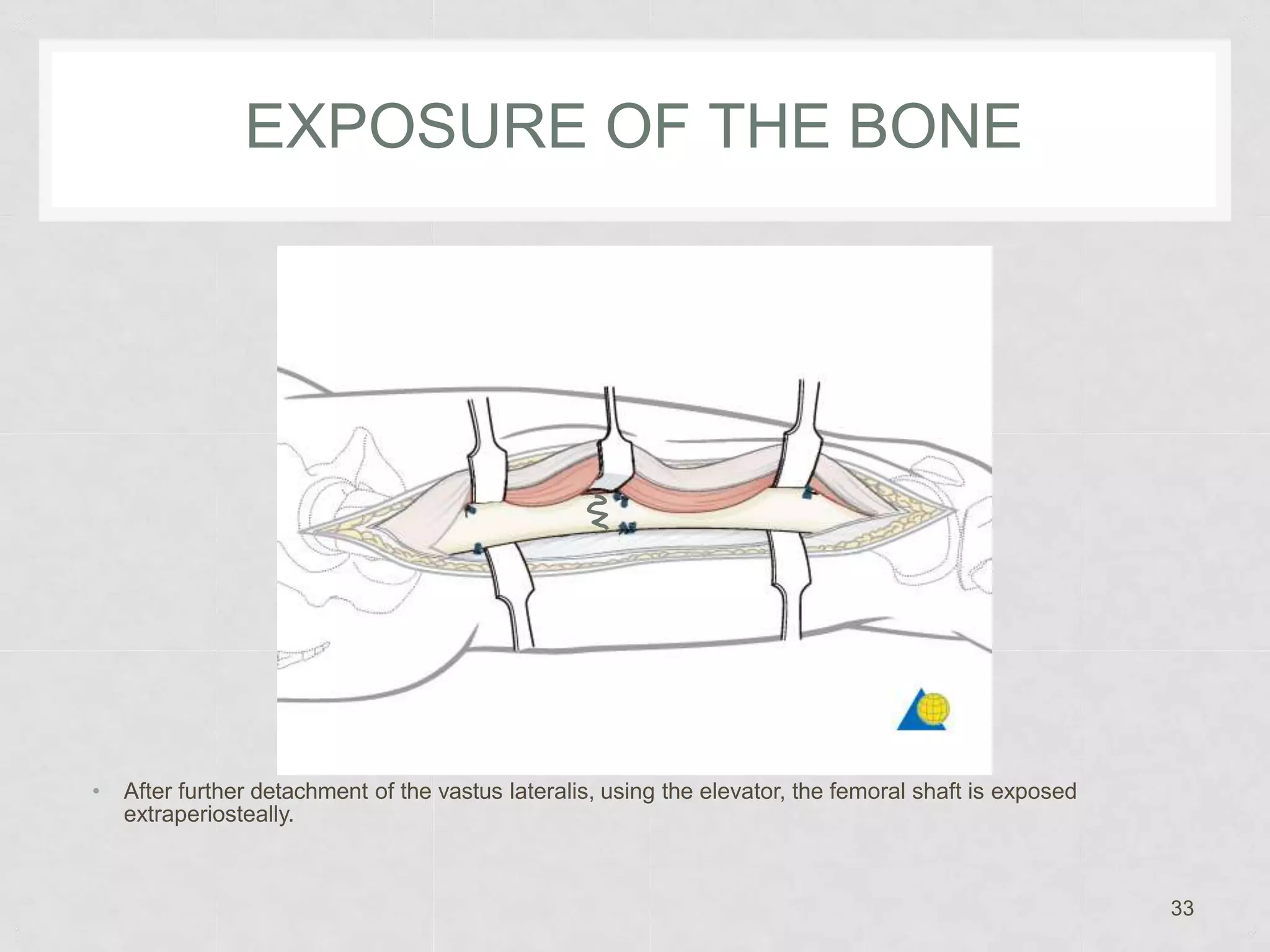 Midshaft femur fracture | PPTX