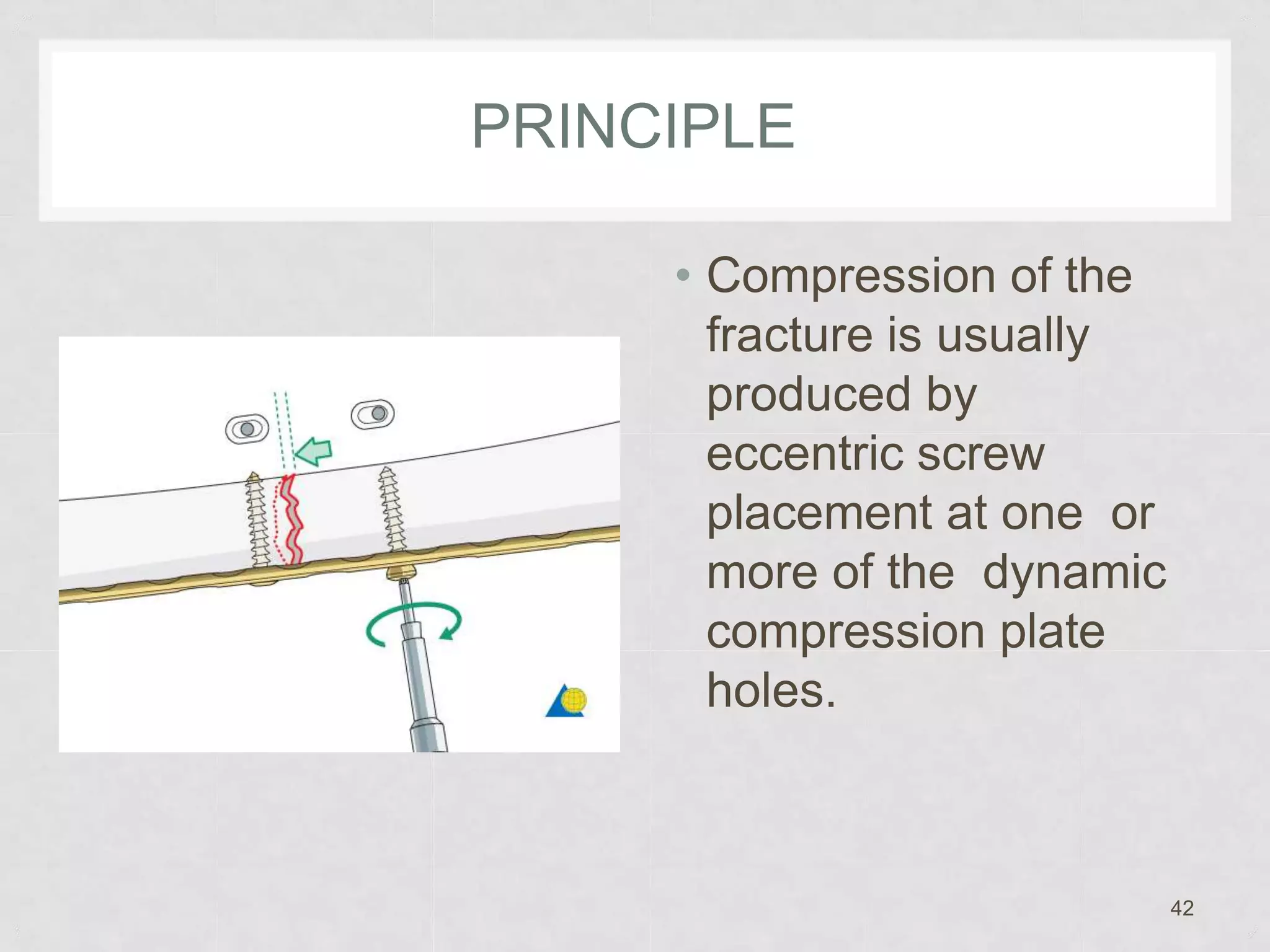 Midshaft femur fracture | PPTX