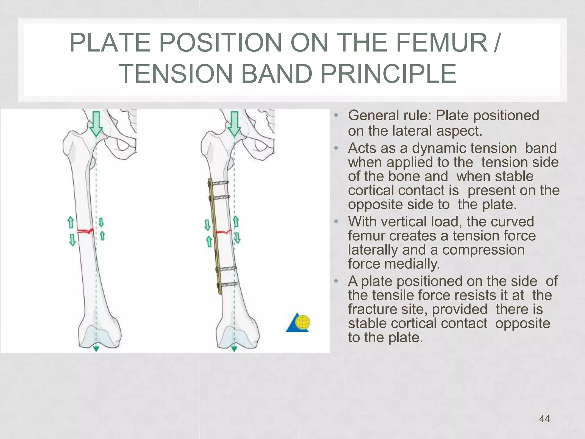 Midshaft femur fracture | PPTX