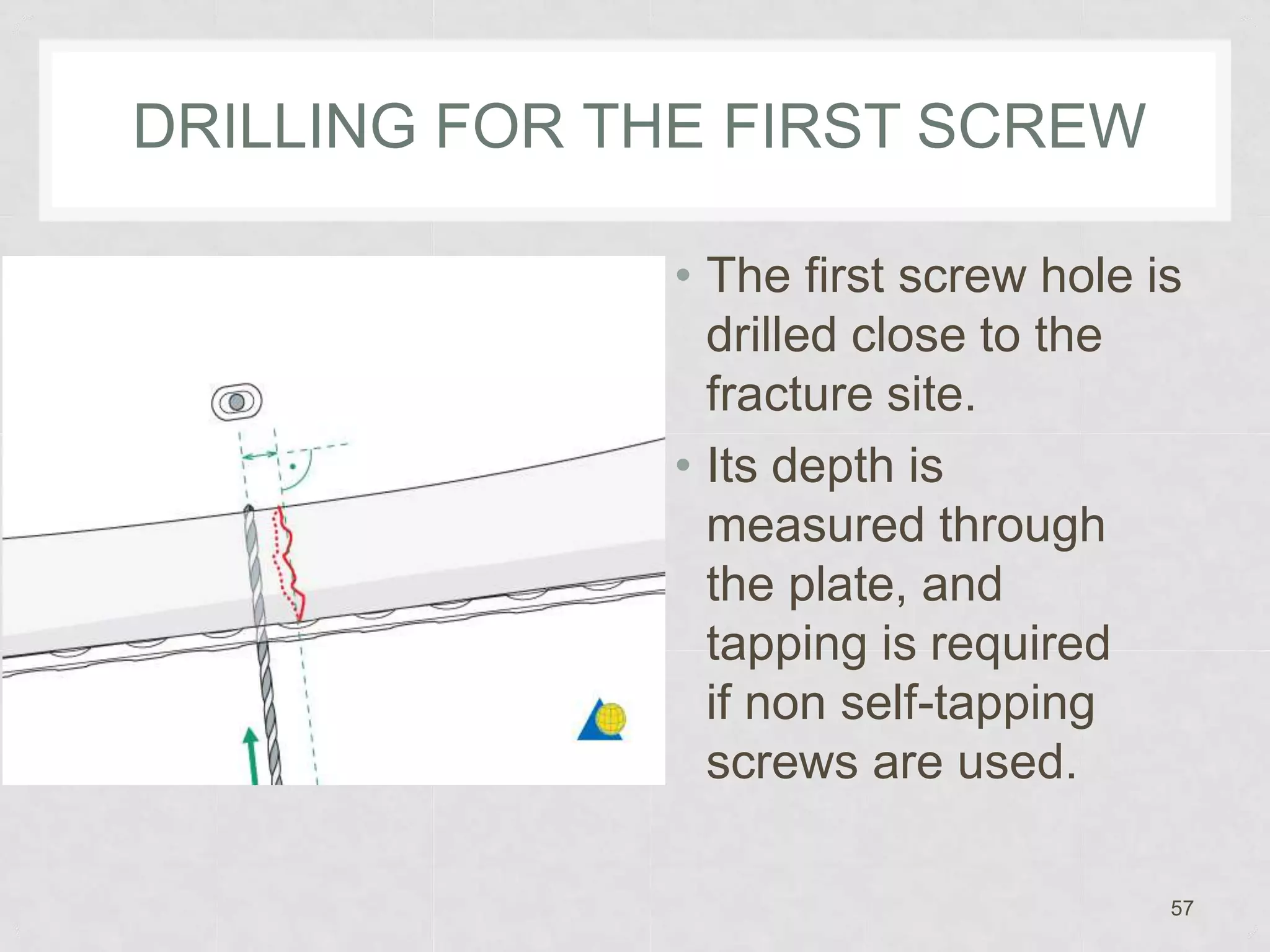 Midshaft femur fracture | PPTX