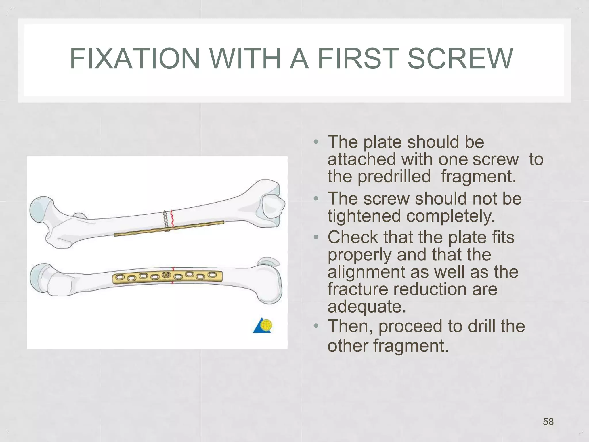 Midshaft femur fracture | PPTX