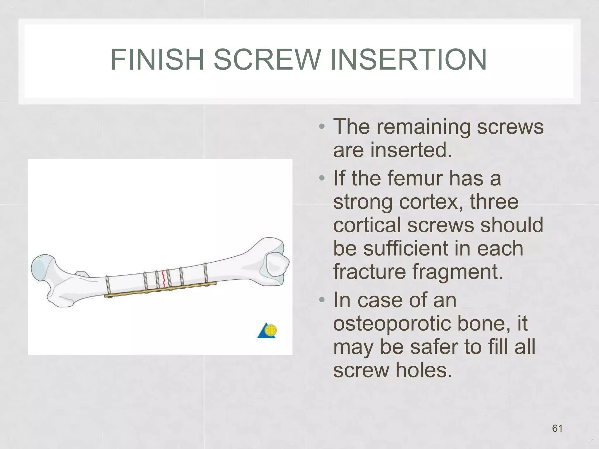 Midshaft femur fracture | PPTX