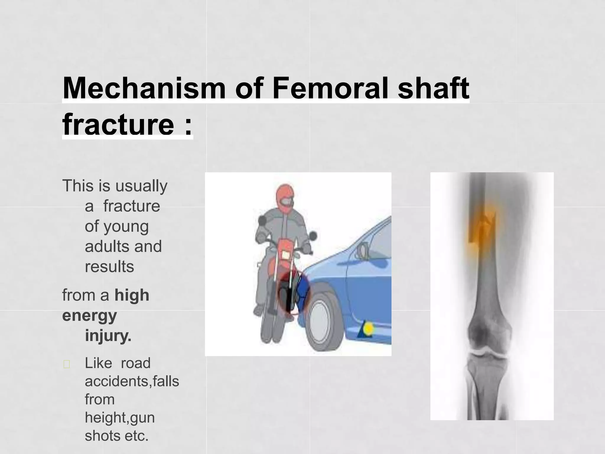 Midshaft femur fracture | PPTX