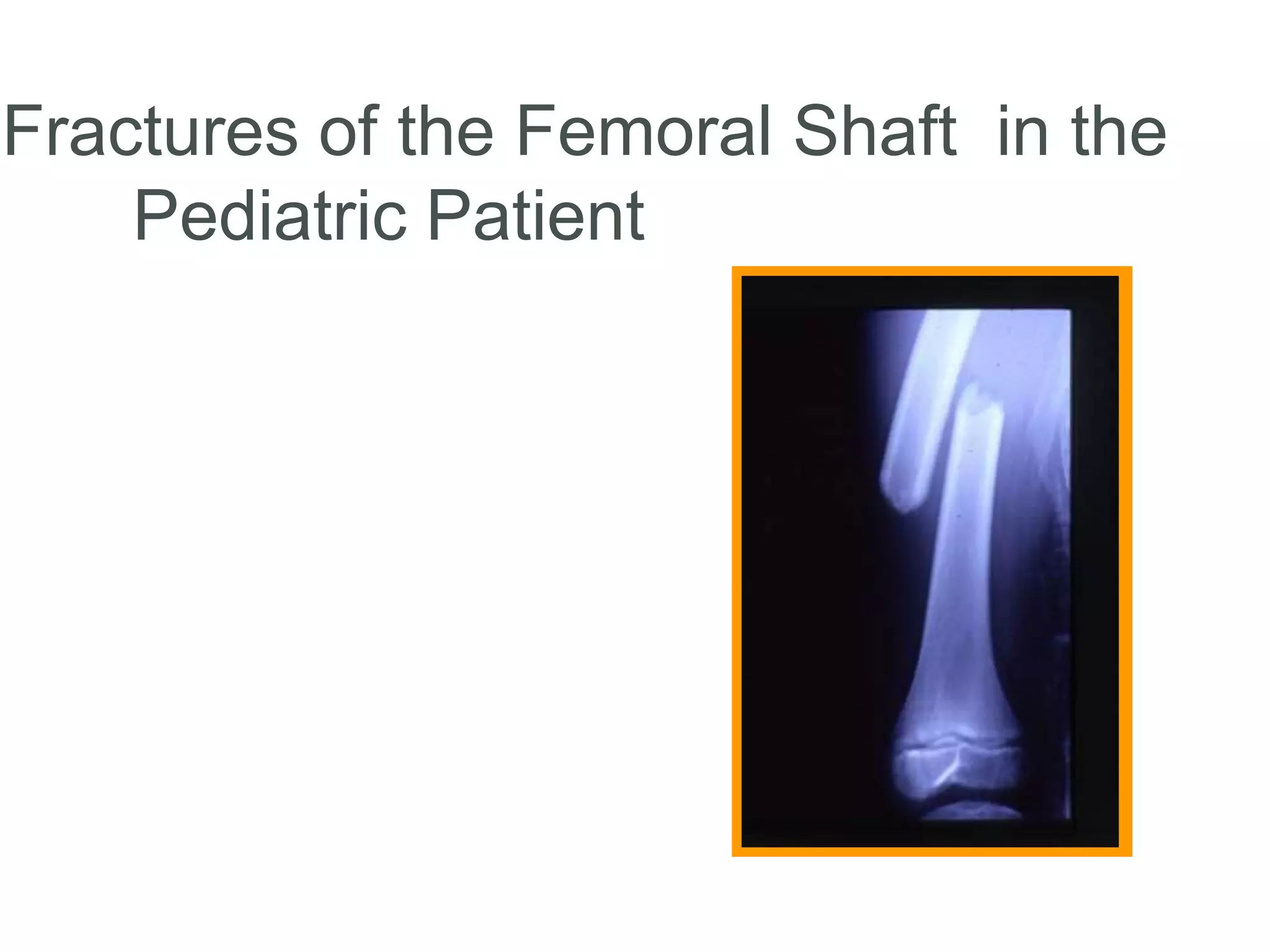 Midshaft femur fracture | PPTX