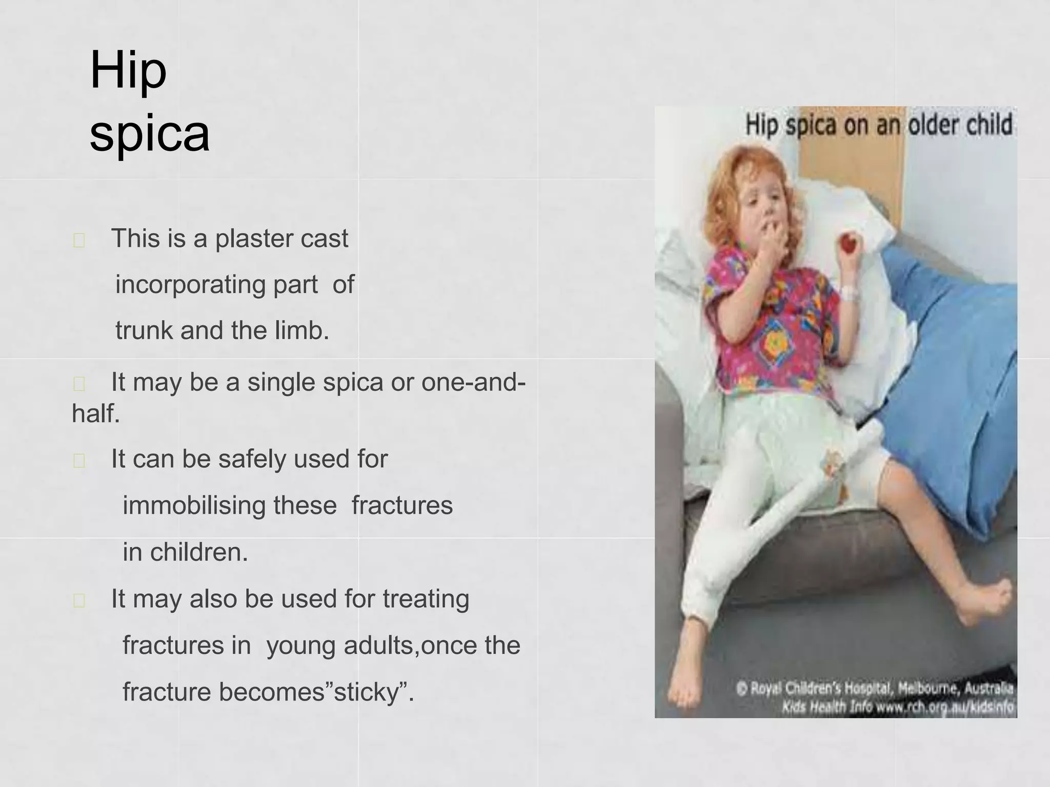Midshaft femur fracture | PPTX