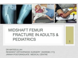 Midshaft femur fracture | PPTX