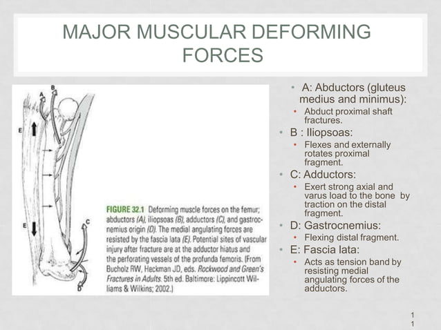Midshaft femur fracture | PPTX