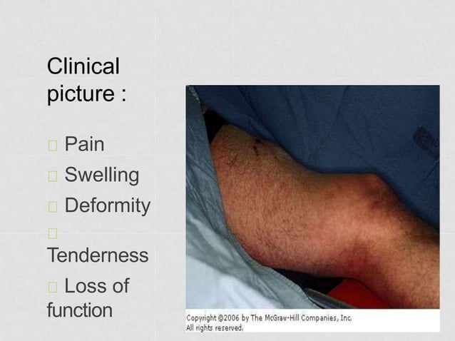 Midshaft femur fracture | PPTX