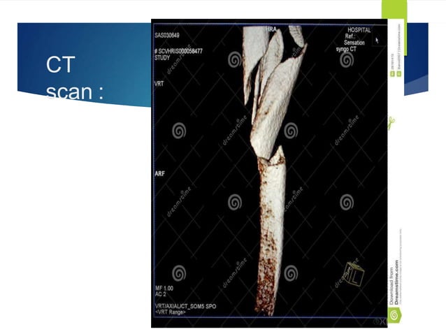 Midshaft femur fracture | PPTX