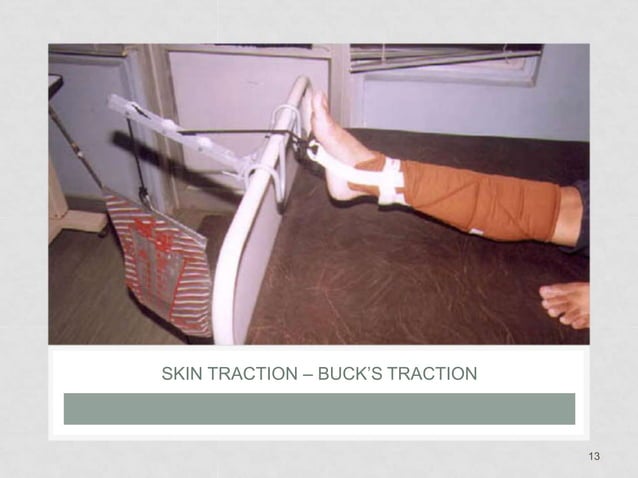 Midshaft femur fracture | PPTX