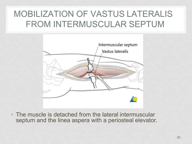 Midshaft femur fracture | PPTX