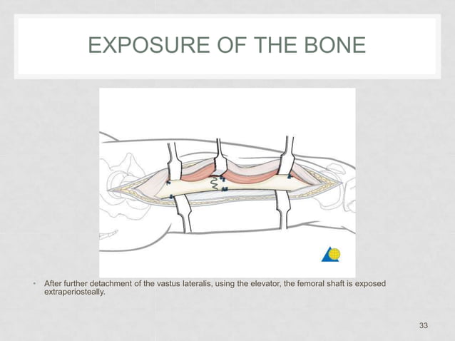 Midshaft femur fracture | PPTX