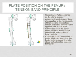 Midshaft femur fracture | PPTX