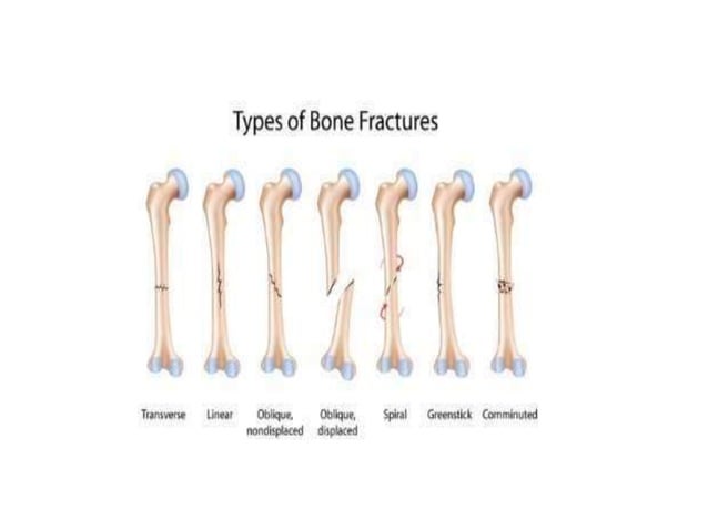 Midshaft femur fracture | PPTX