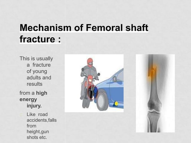 Midshaft femur fracture | PPTX